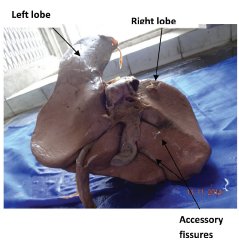 Showing accessory fissure with superior and inferior quadrate lobe.