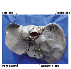 Absence of fissure for ligamentum teres was seen in 9(11.2%) specimens ...