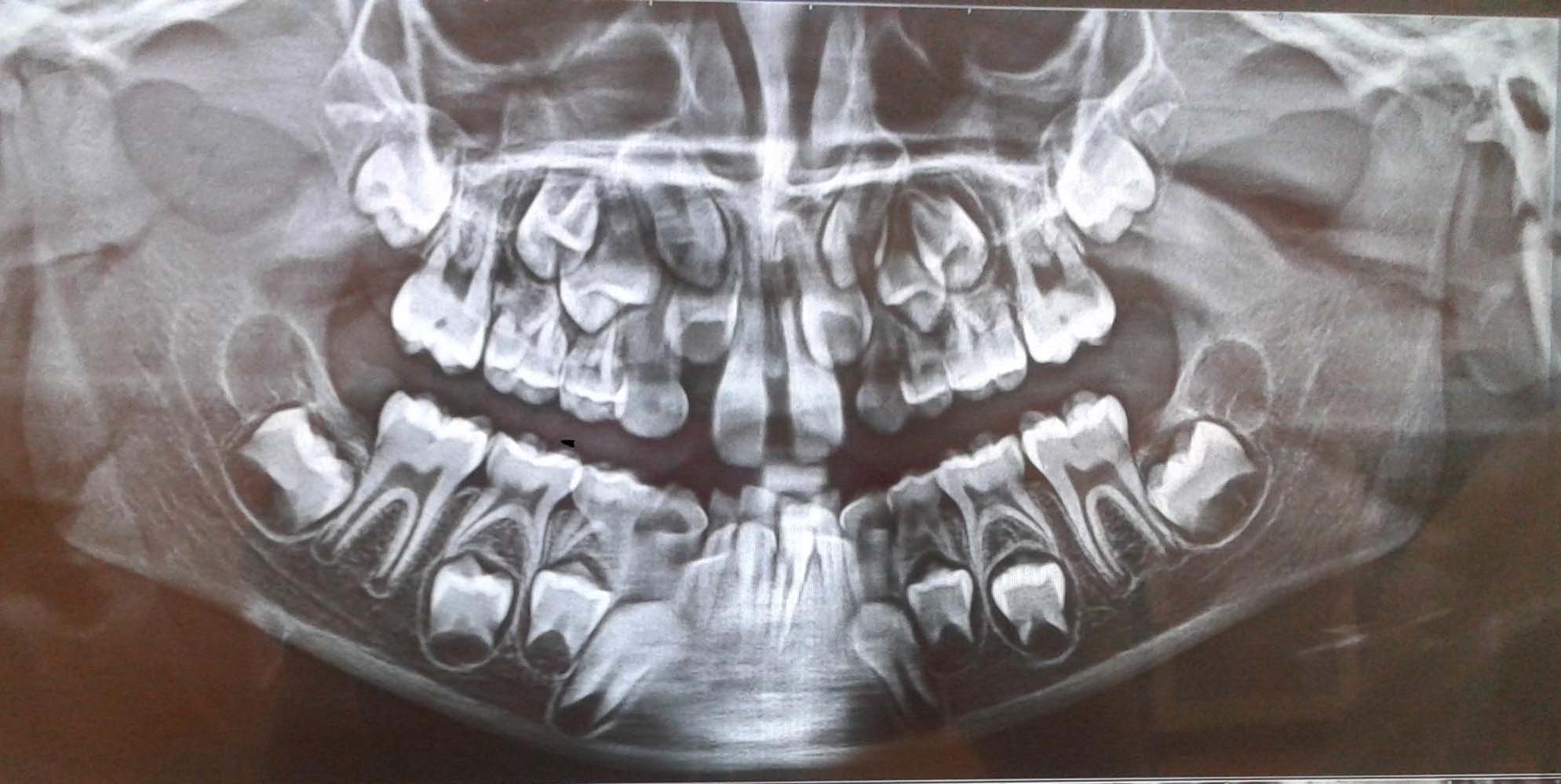 Orthopantomogram showing bilateral deciduous canine.