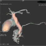 MRCP showing abrupt cut off of distal CBD with double duct sign.