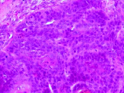 H&E stain, 40X, showing malignant squamous cells.