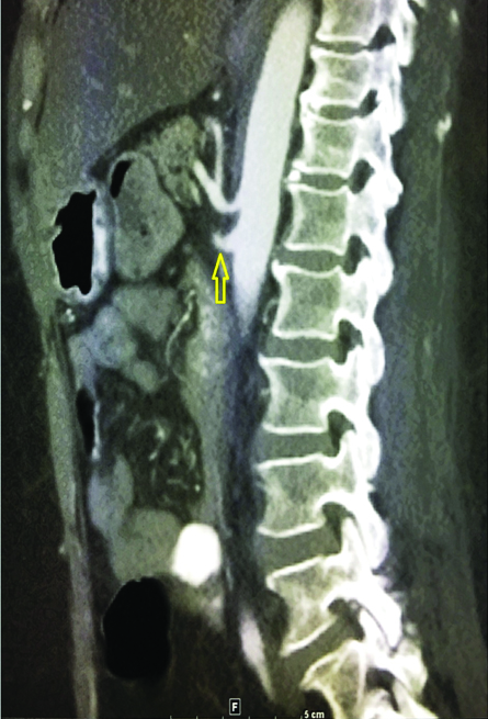 Computed Tomography Angiography (CTA) showing hook like morphology of ...