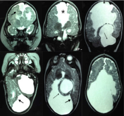 She developed refractory epilepsy and profound developmental delay with ...