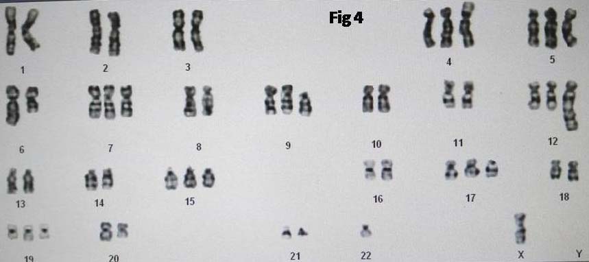 Chromosomal analysis of peripheral blood showing a complex karyotype.