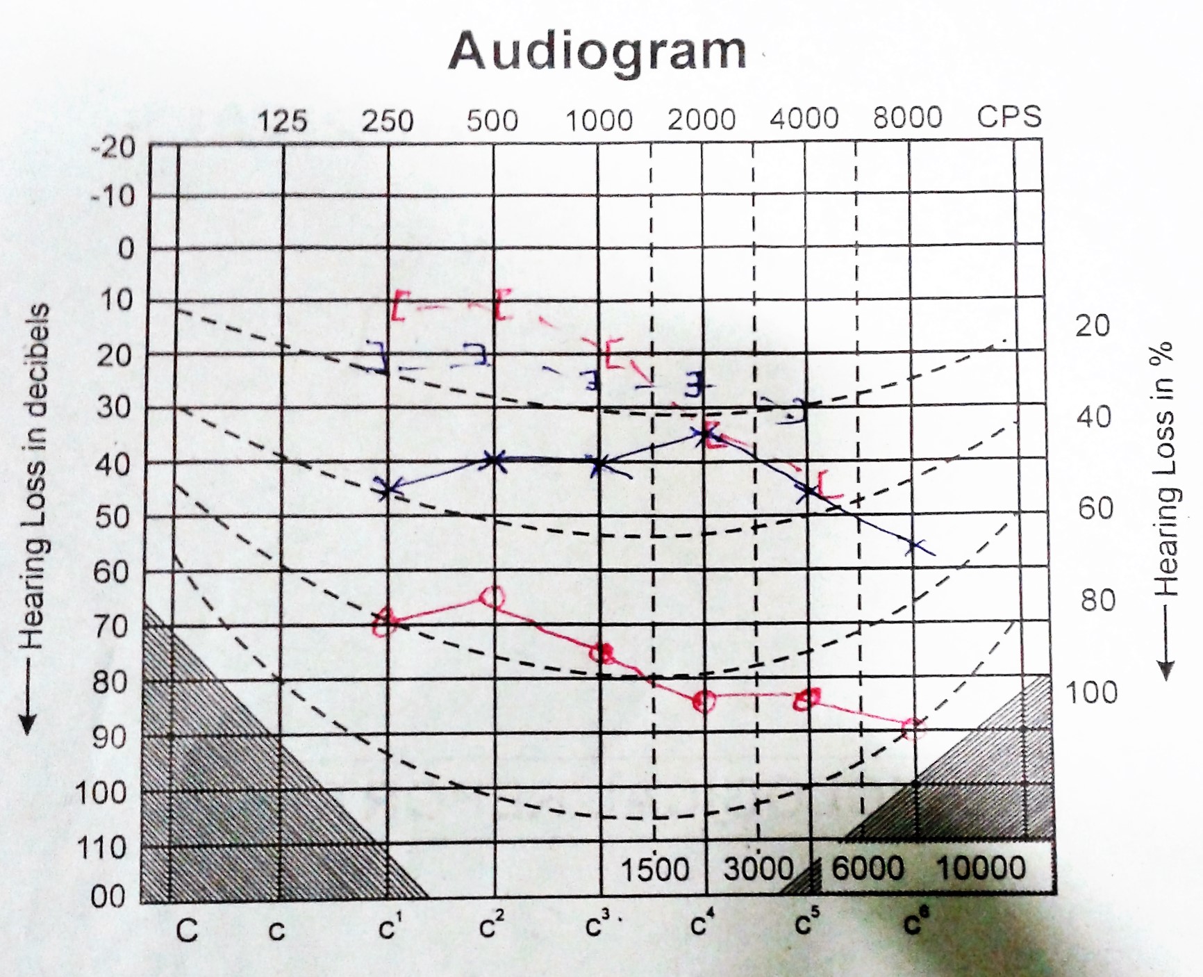 Tympanic Membrane Perforation Audiogram