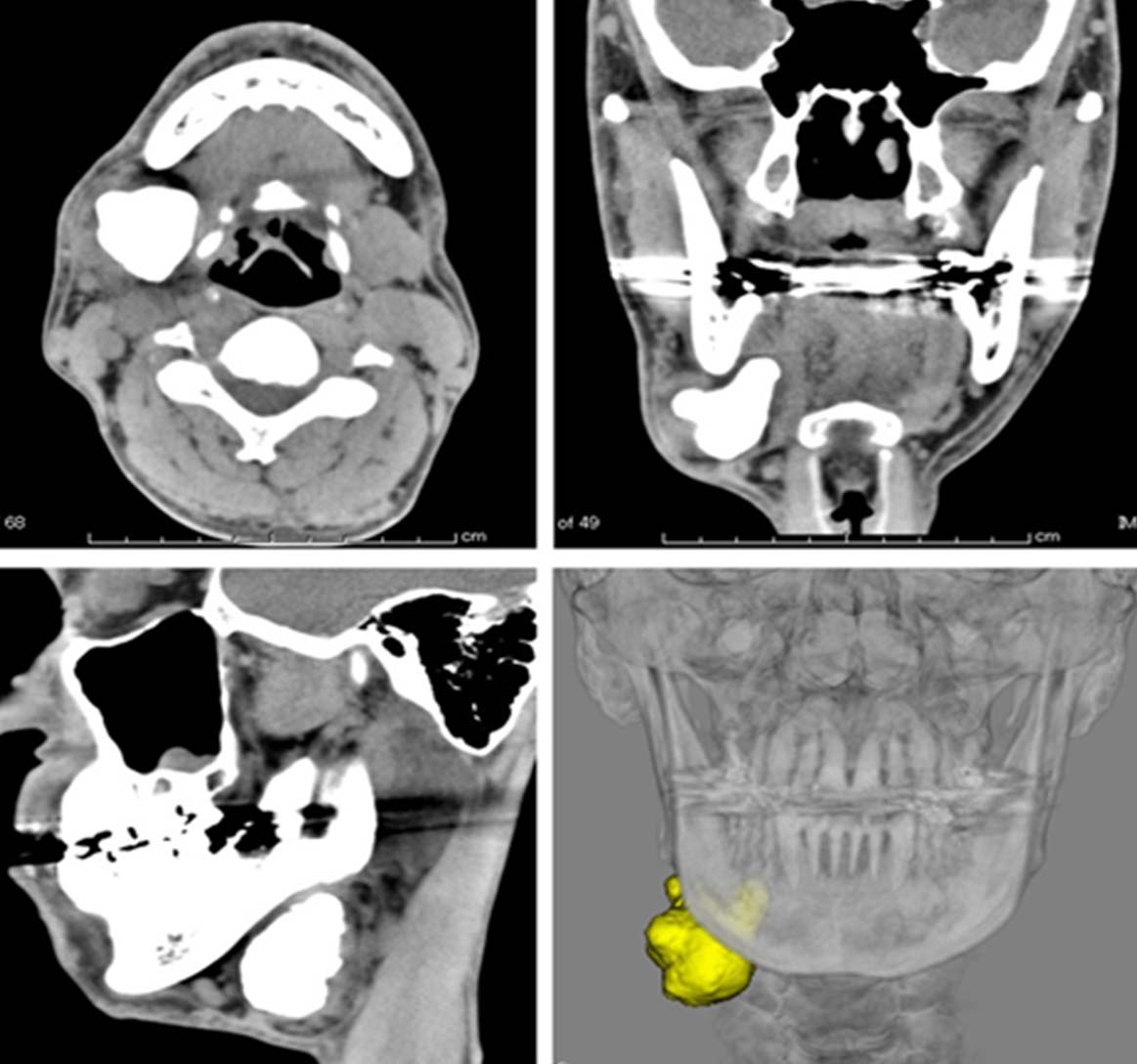Computed tomography with three-dimensional reconstruction showing a ...