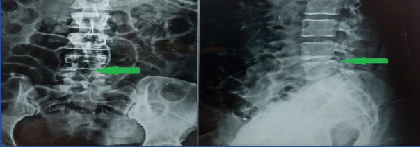 Postoperative X-ray showing L4-L5 decompression.