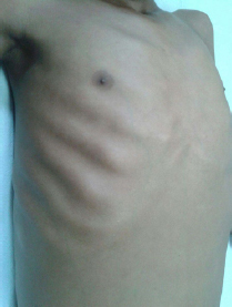 Rachitic rosary due to vitamin D deficiency