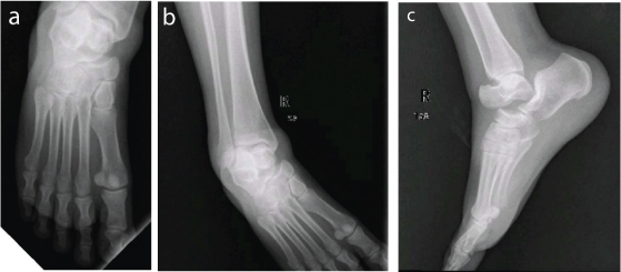 Calcaneocuboid Dislocation