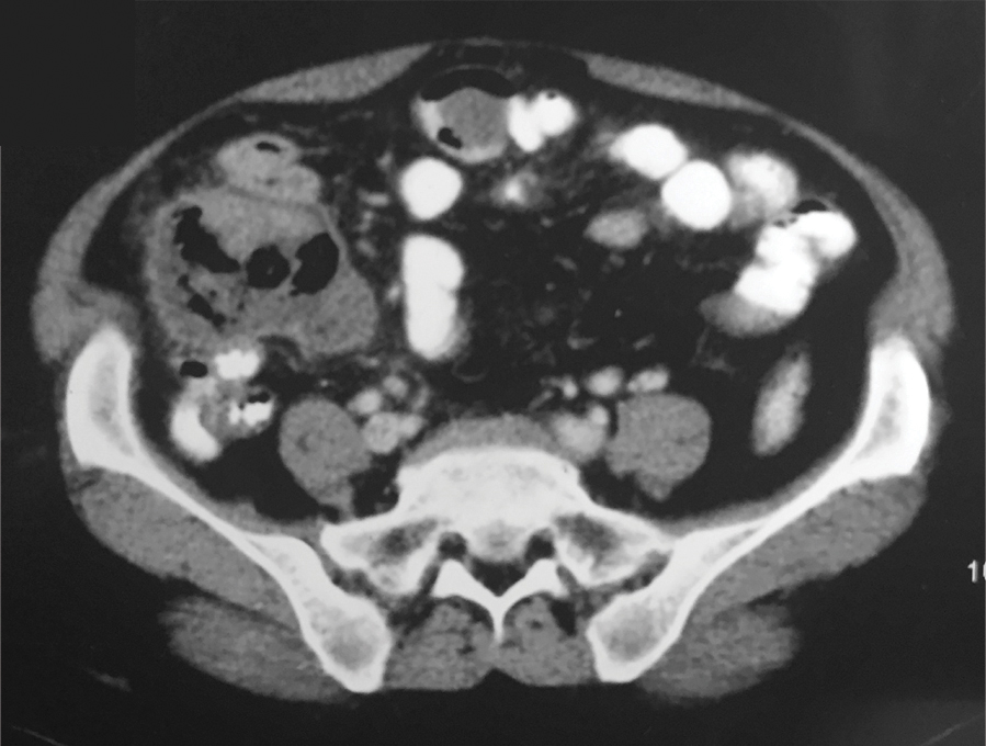 CECT abdomen showing an encapsulated abscess in RIF in close contact ...
