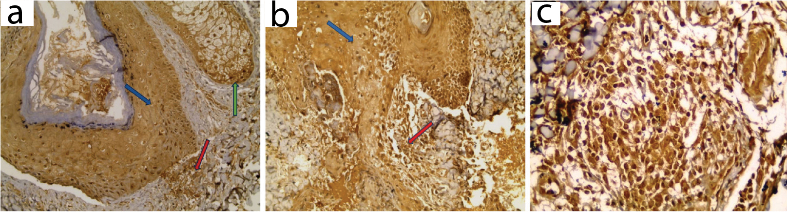 COX2 Expression in Perilesional Skin