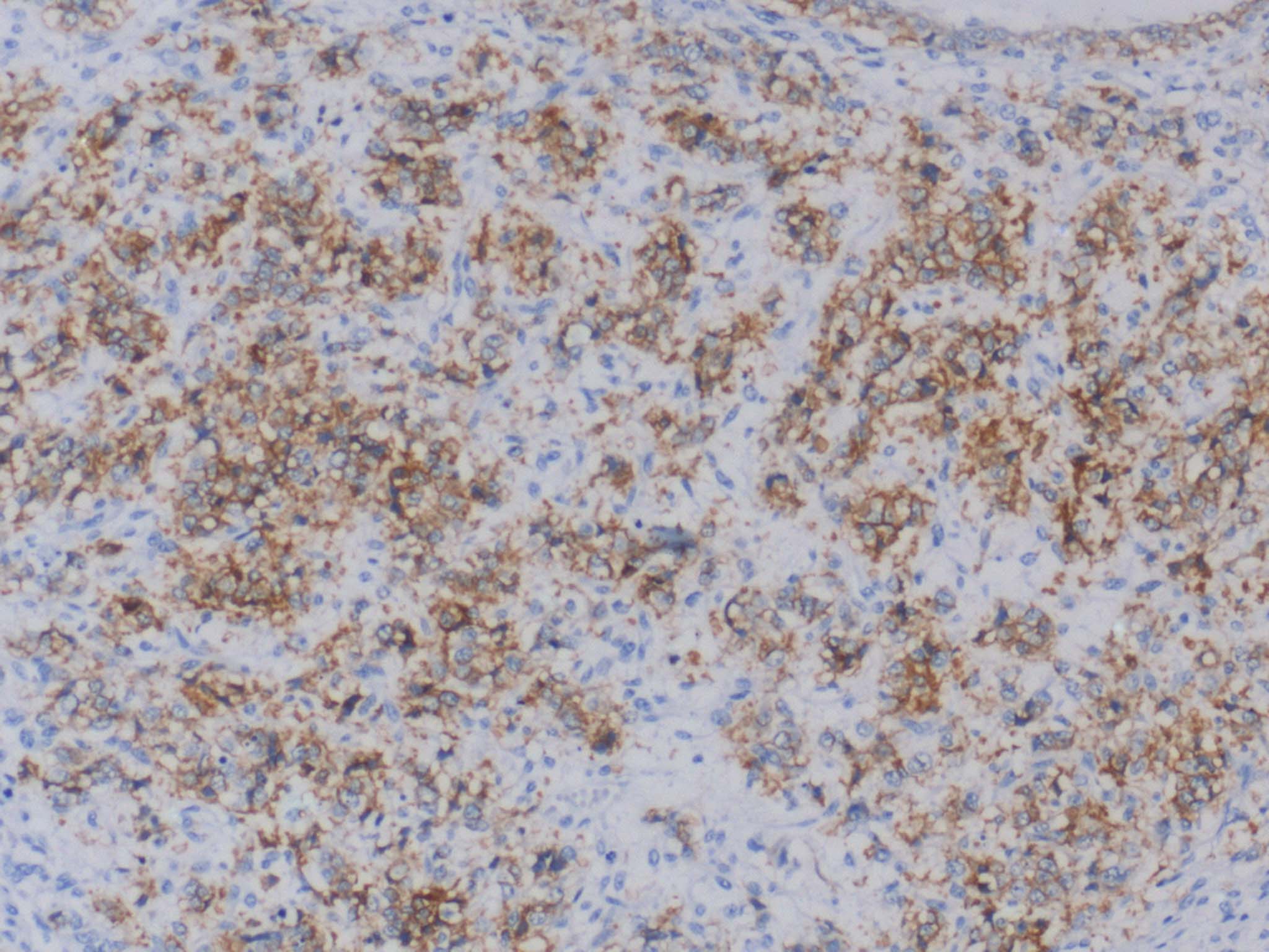 IHC shows diffuse membranous positivity for CD99 (10X).