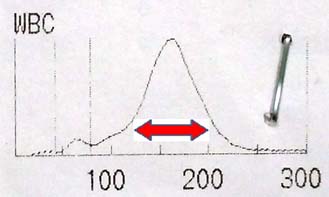 WBC histogram of case 1. Red arrow is marked in the region of myelocyte ...