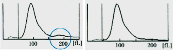 a) RBC histogram of case 6 showing an additional small peak at 180 fL ...