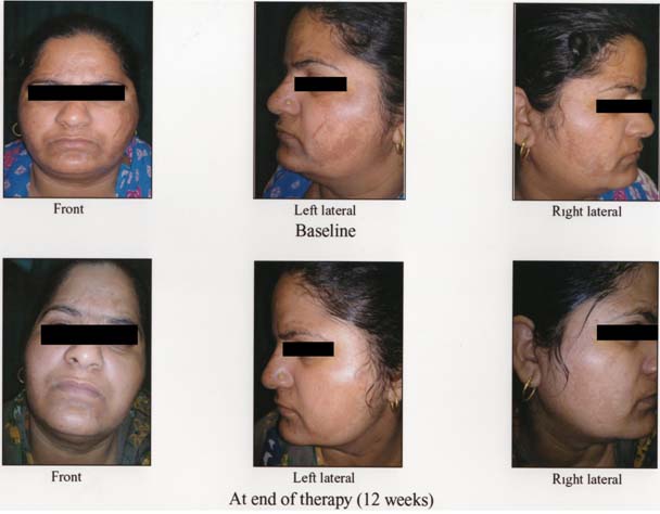 Melasma before and after treatment in control group.
