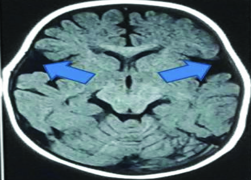 MRI image (T1 weighted axial section) of a case showing prominence of ...