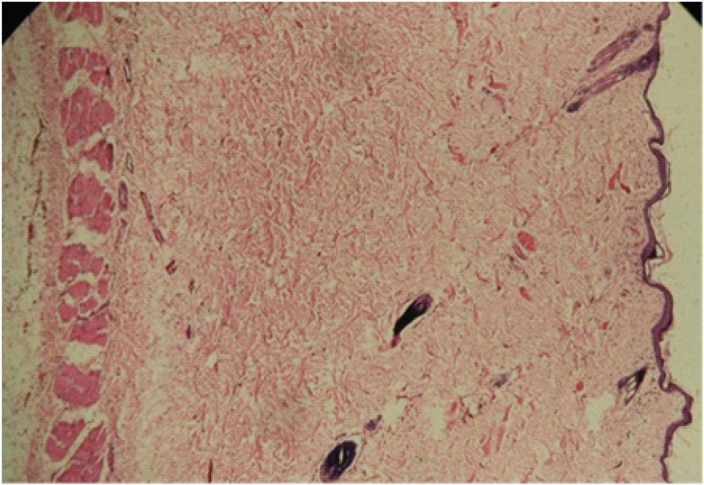 Control at 3 months. Shows mild keratinized epithelium with mild ...