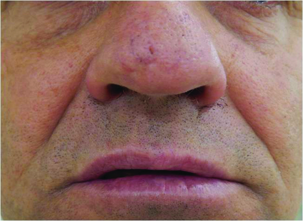 The appearance of the upper lip and nose were normal after treatment of ...