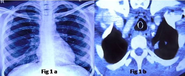 a) Grossly normal chest radiograph (PA view); b) CT thorax showing ...