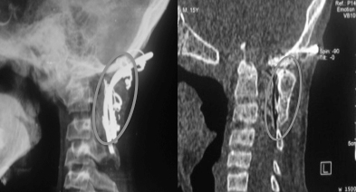Postoperative X-ray CV junction showing incomplete bony fusion (arrow ...