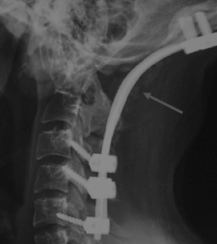 Postoperative X-ray CV junction-lateral view showing absent fusion at ...