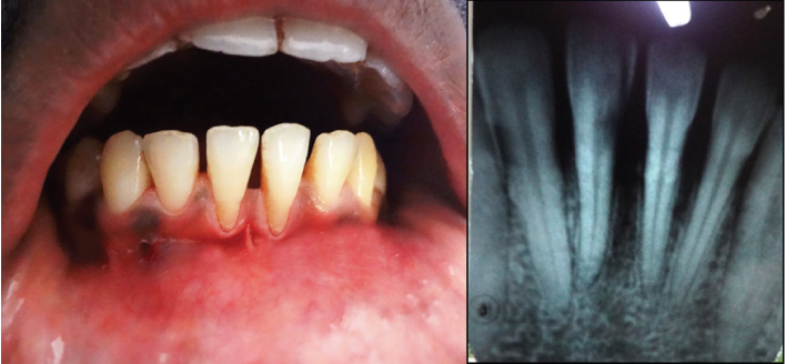 The treatment plan was explained and a written informed consent was ...