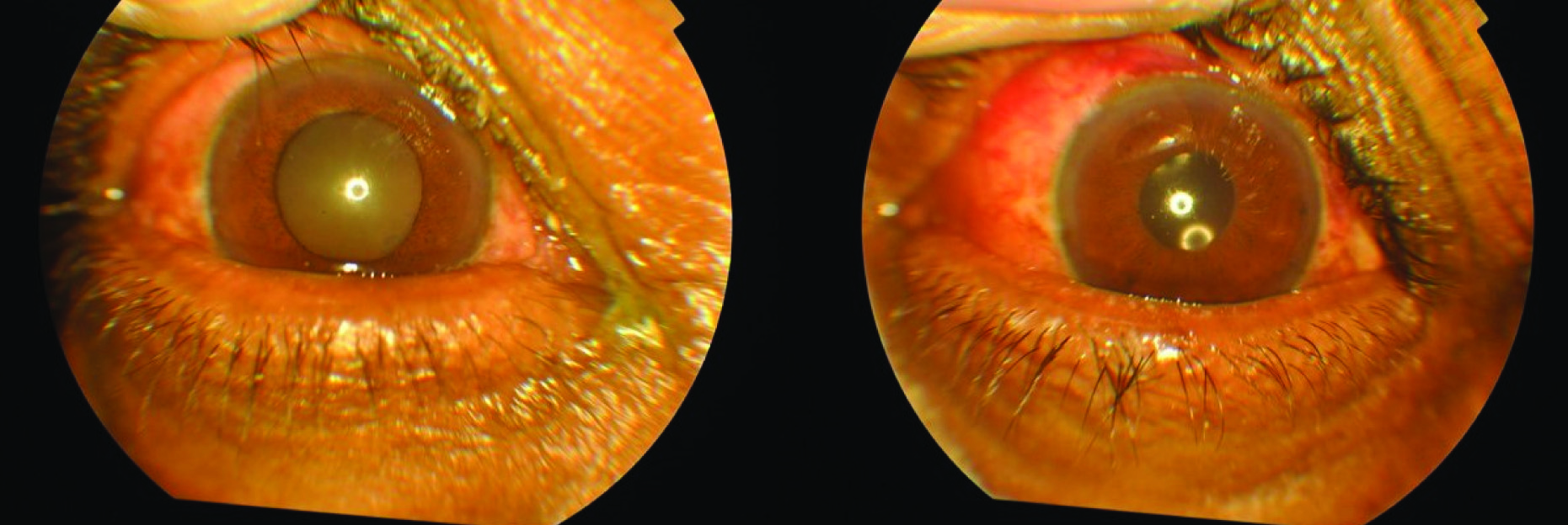 Shallow Anterior Chamber With Pupillary Block