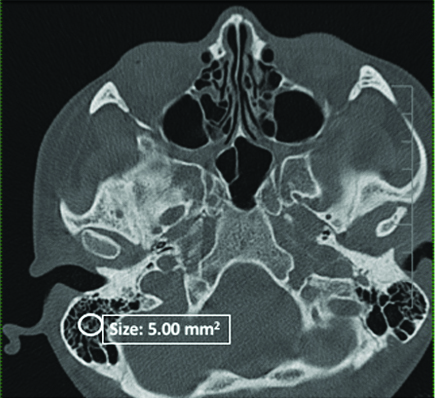 Mastoid Air Cells