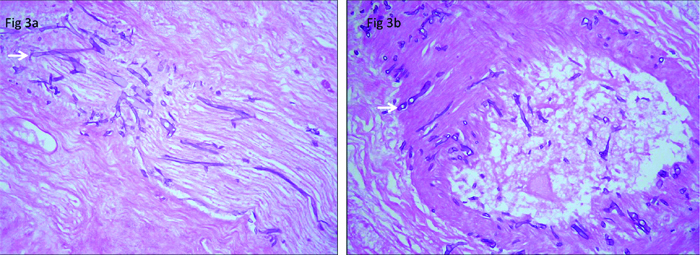 a) Neural invasion by fungal hyphae (H&E, 400X); b) Vascular wall ...