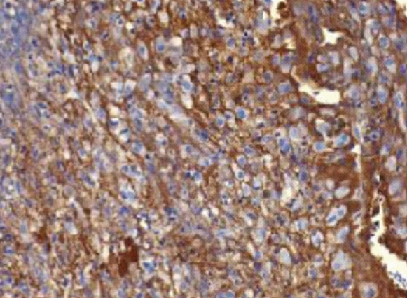 Immunohistochemistry staining showing positive staining for lambda chains.