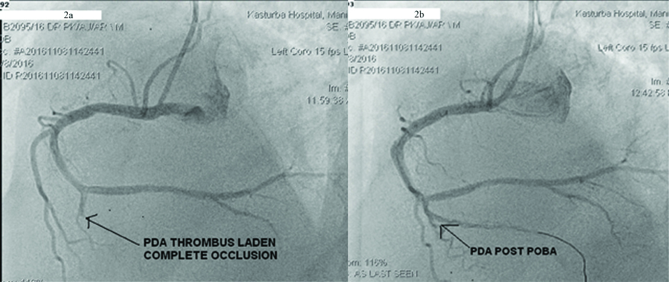 a) Coronary angiography showed proximal PDA thrombotic 100% occlusion ...