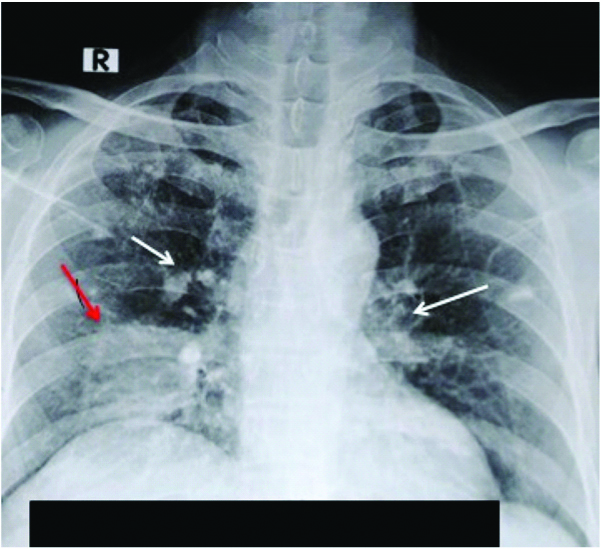 Chest CT scan showed a mass in right lower lobe with speculated ...