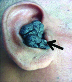 After clinical examination, a differential diagnosis of melanoma and ...