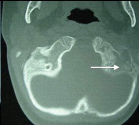 CT scan of the head, bone window, showing osteolyitc lesion on the left ...