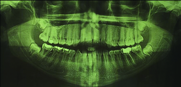No evidence of bone involvement in panoramic radiography.