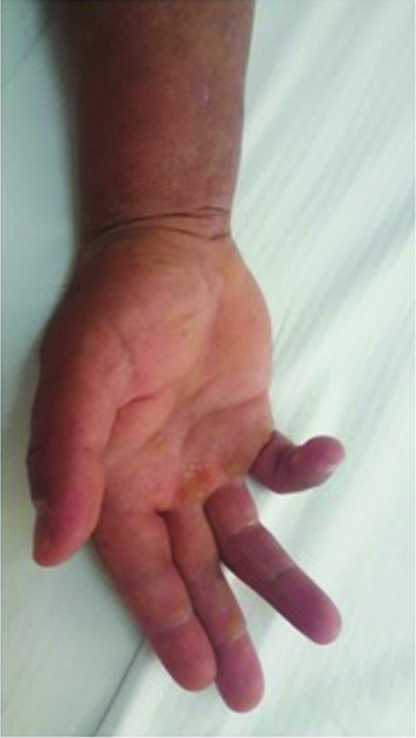 Right hand clinical appearance.