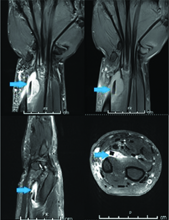 Right wrist MRI coronal, sagittal and axial sequence view.