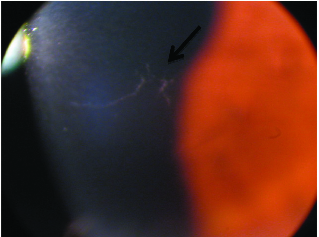 Slit lamp examination of the left eye plus slit lamp photography ...