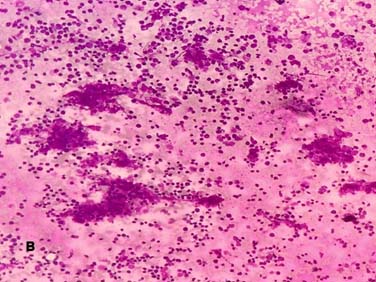 Grade III (Severe): Florid lymphocytic inflammation with germinal ...