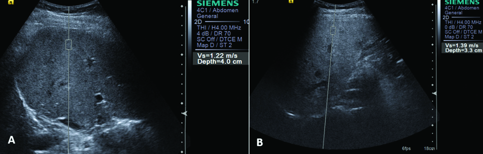 ARFI measurement in patient with grade 3 fatty liver.