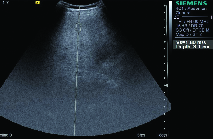 ARFI values in alcoholic and non-alcoholic fatty liver patients.
