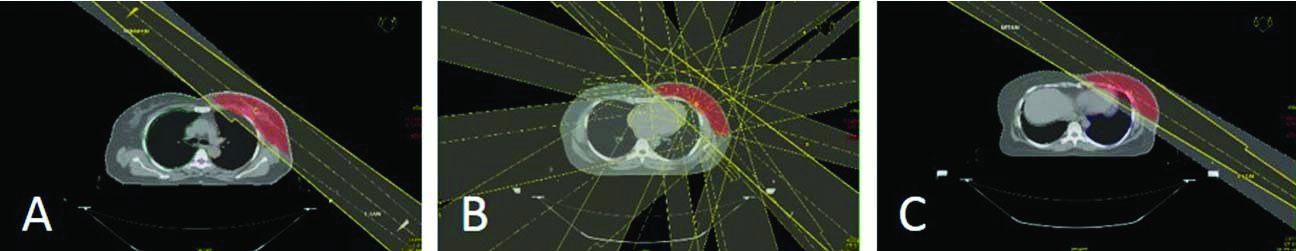 a) Medial and Lateral Tangential wedge beams in 3DCRT; b) Multiple ...