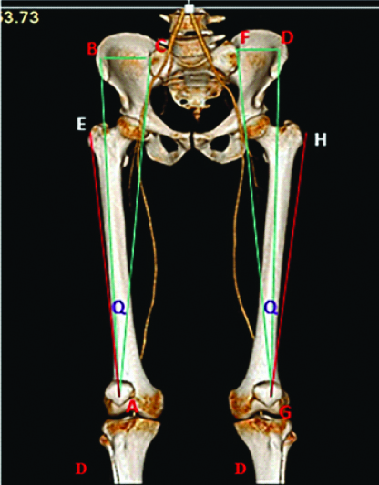 Line tangent to the posterior epicondyle (LM). (Left)