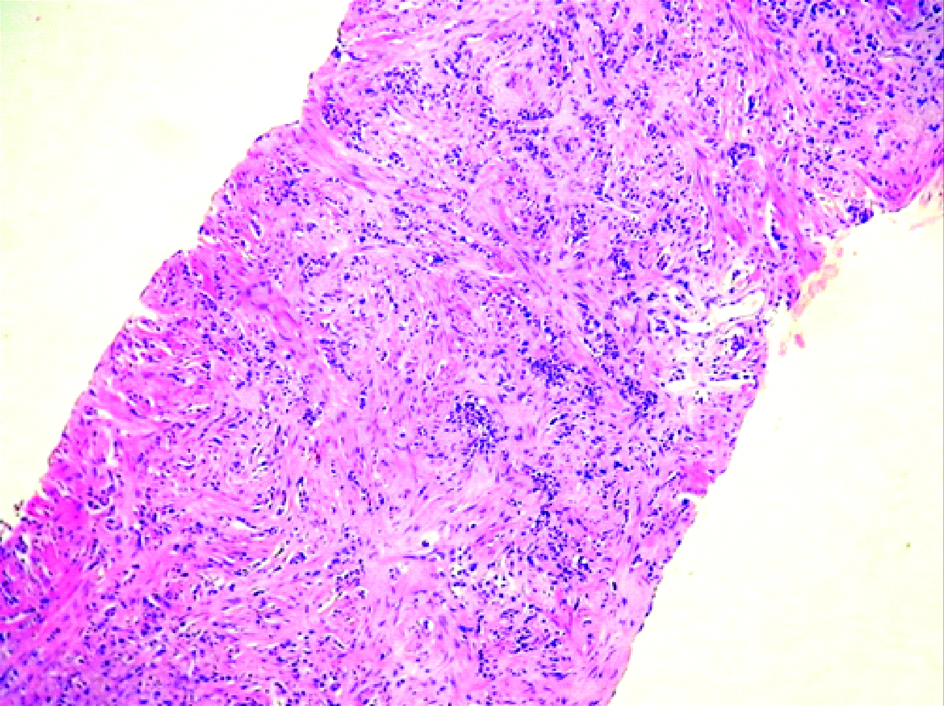 Hypernephromatoid pattern of prostatic adenocarcinoma (H&E, 400X).