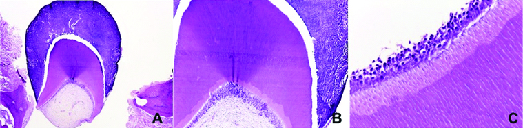 a,b) Histopathological aspects of compound odontoma, showing a ...