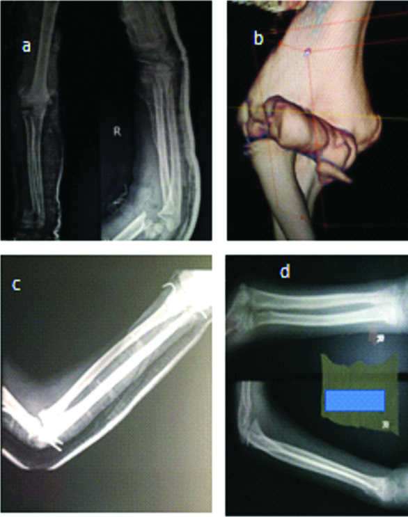 Case detail (case 2) showing floating elbow in a 12 years old child who ...