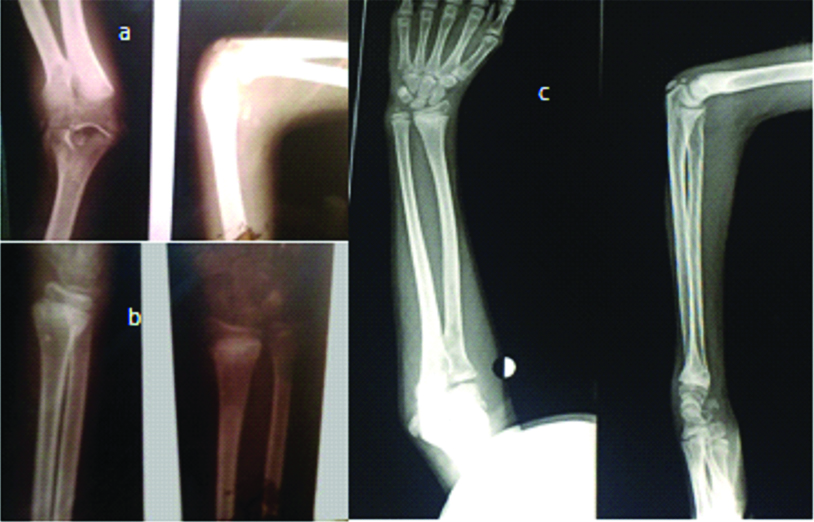 Follow-up (case 4) of floating elbow (Cuéllar-Nieto type I) right side ...