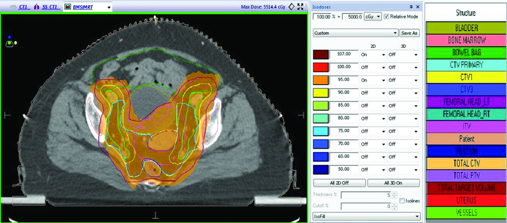 DVH showing normal and BMS-IMRT plan.