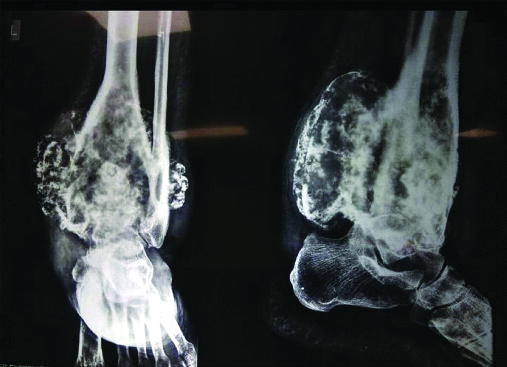 X-ray of patients showing malignant degenerative changes in long ...