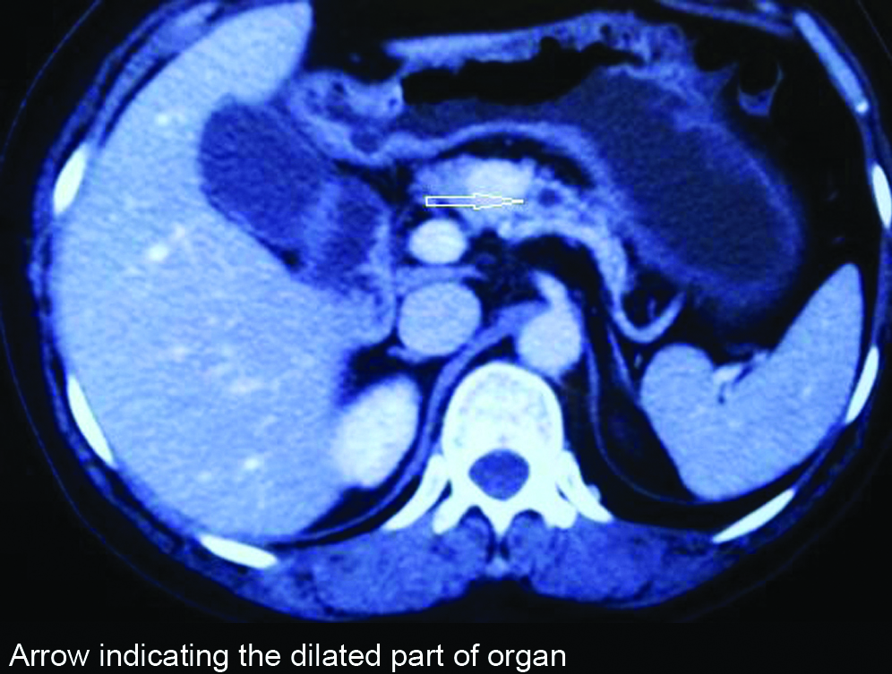 Computer Tomography of NET presenting as ampullary polyp causing ...